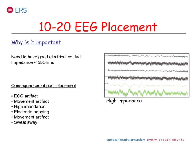 IDEAL Lead Placement IN EEG-10-20 SYSTEM.pdf