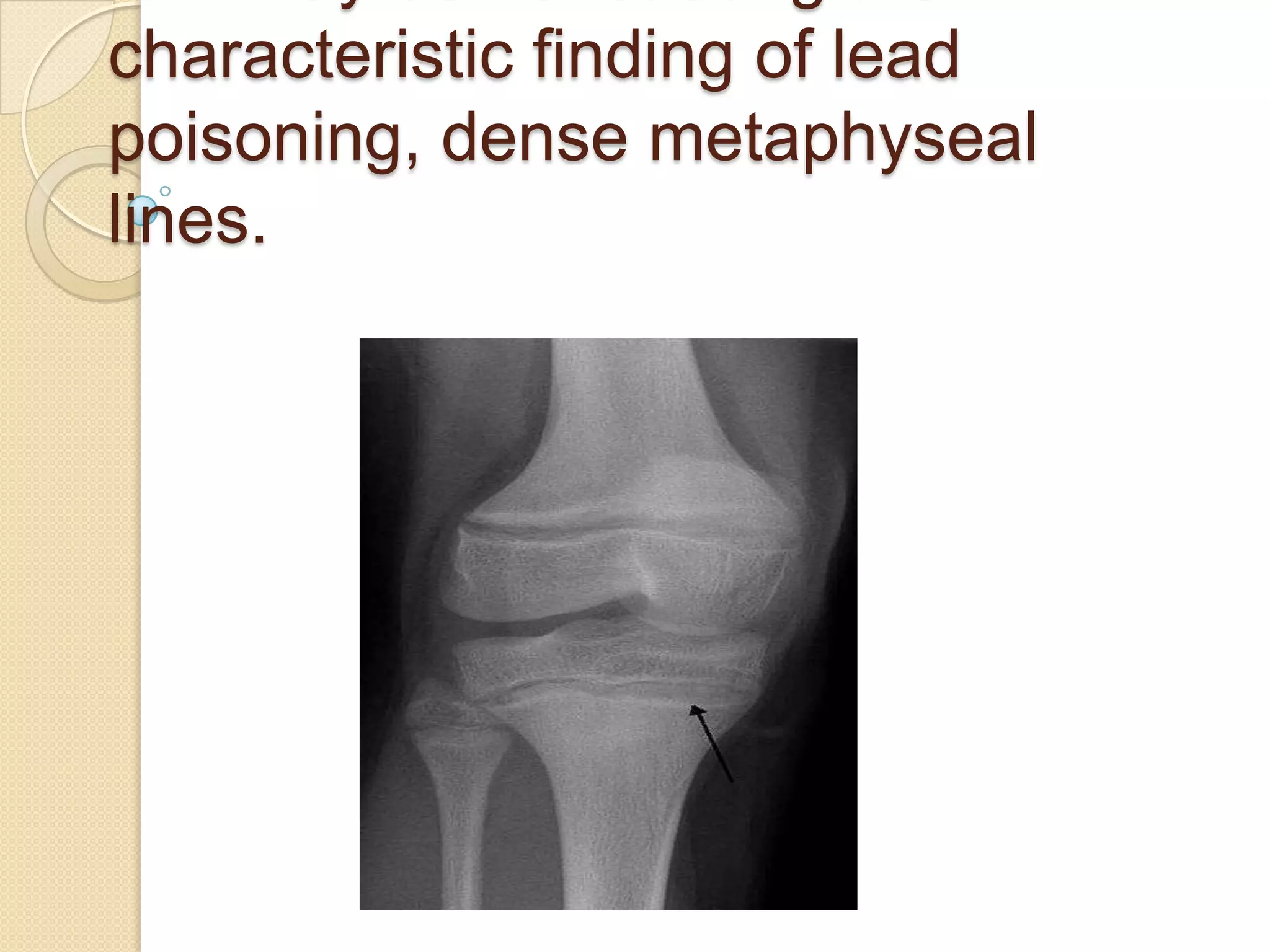 Lead poisoning | PPTX