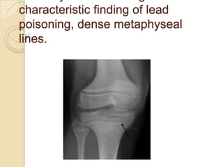 Lead Poisoning Xray