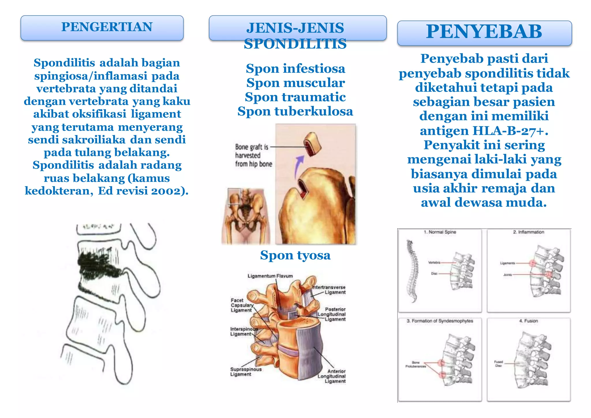 Leaflet spondilitis | DOCX