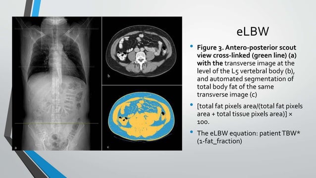 Lean body weight in contrast media CT Scan | PPT