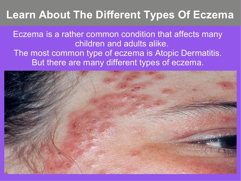 Learn about the different types of eczema