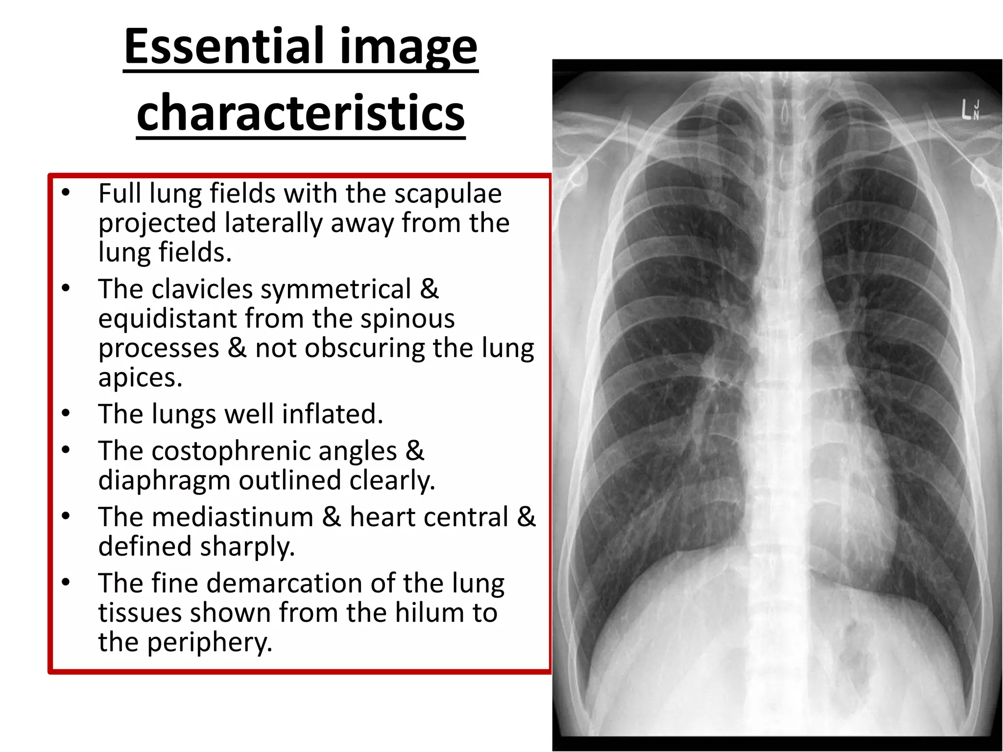 Learn Chest X-Ray With Its Normal Positioning & Radio-Anatomy | PPTX