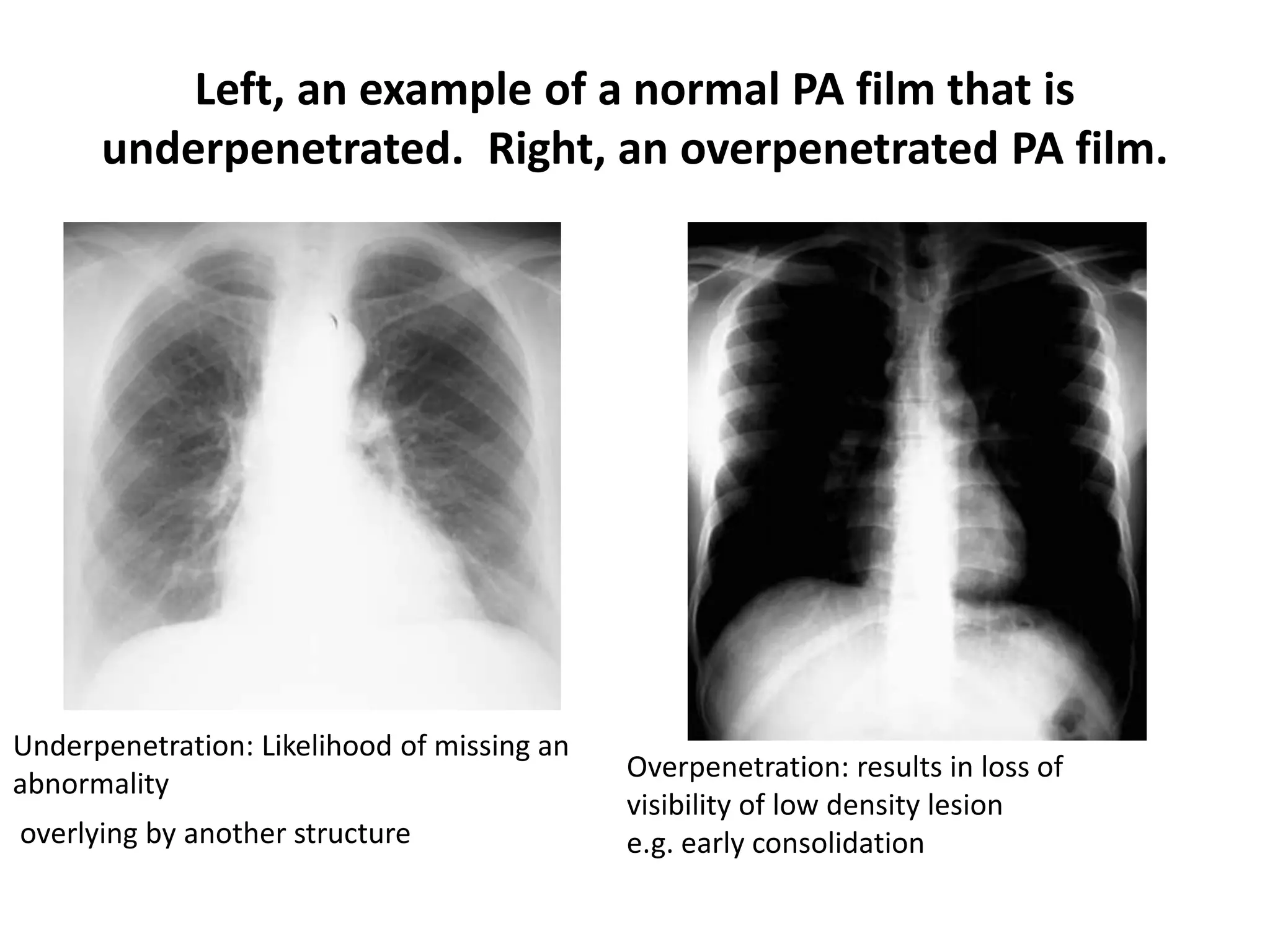 Learn Chest X-Ray With Its Normal Positioning & Radio-Anatomy | PPTX