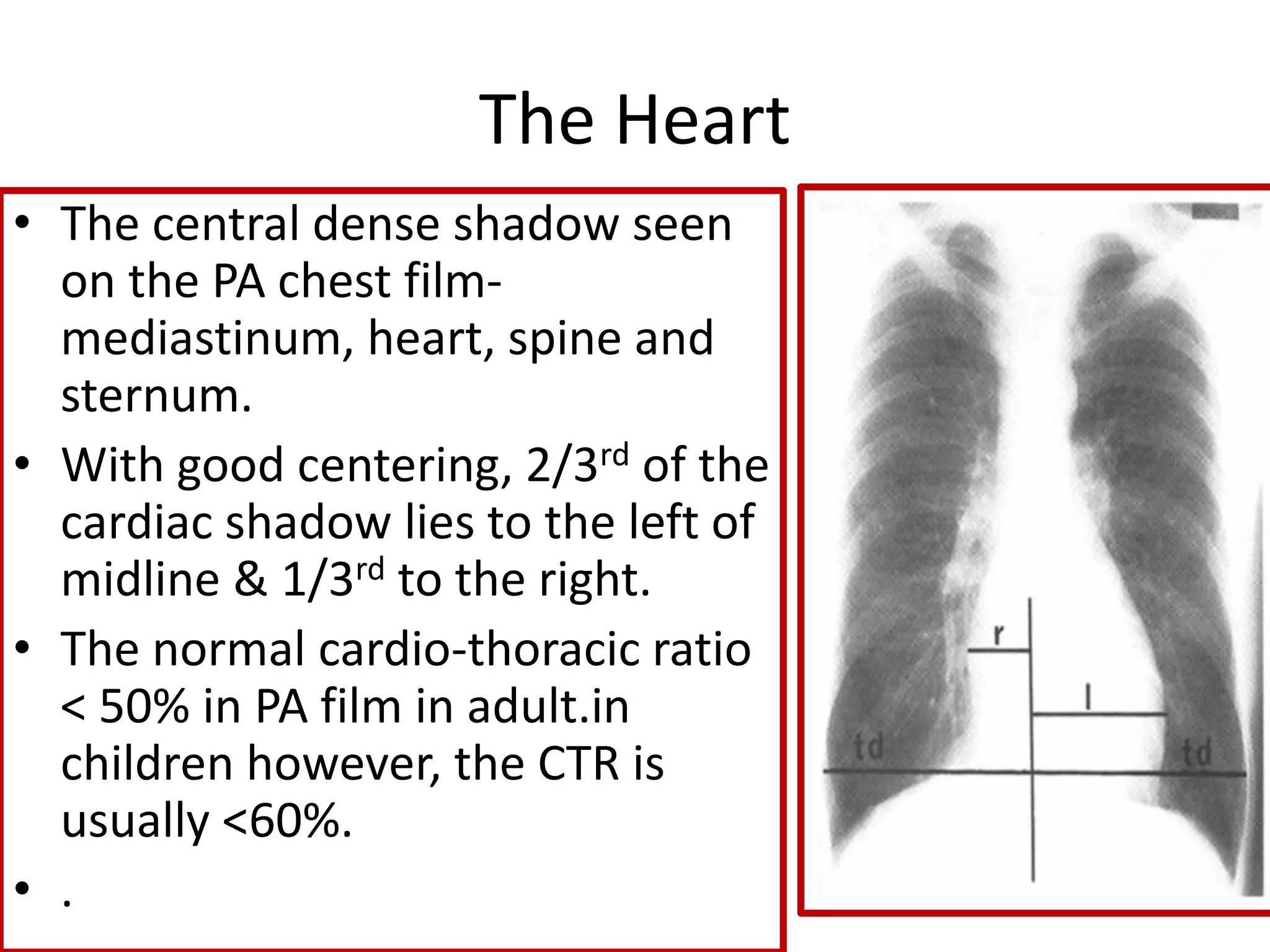 Learn Chest X-Ray With Its Normal Positioning & Radio-Anatomy | PPTX