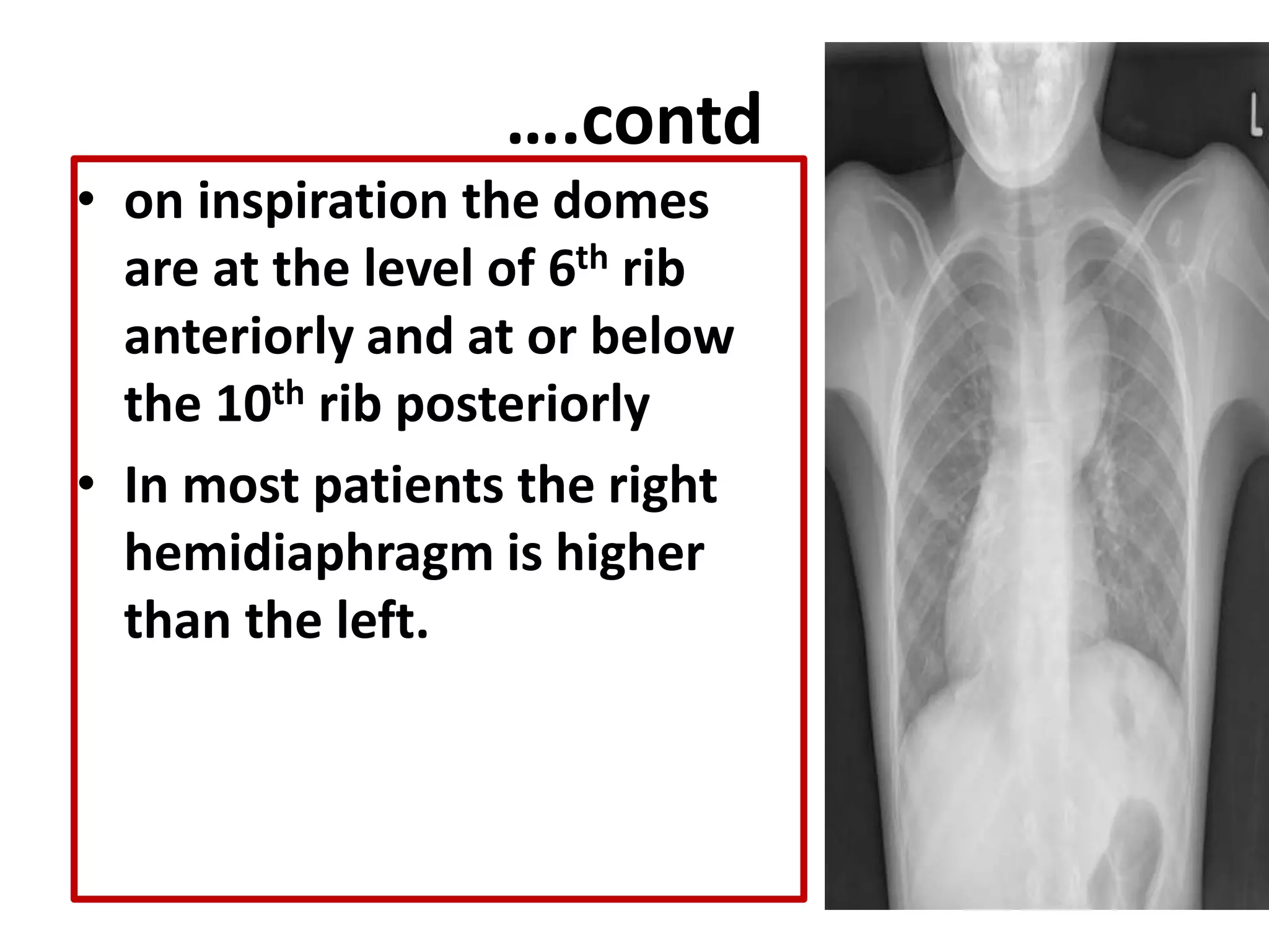 Learn Chest X-Ray With Its Normal Positioning & Radio-Anatomy | PPTX