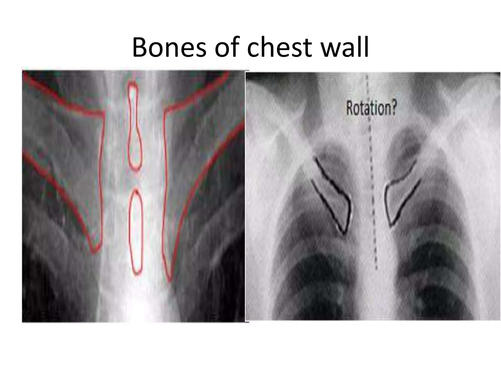 Learn Chest X-Ray With Its Normal Positioning & Radio-Anatomy | PPTX