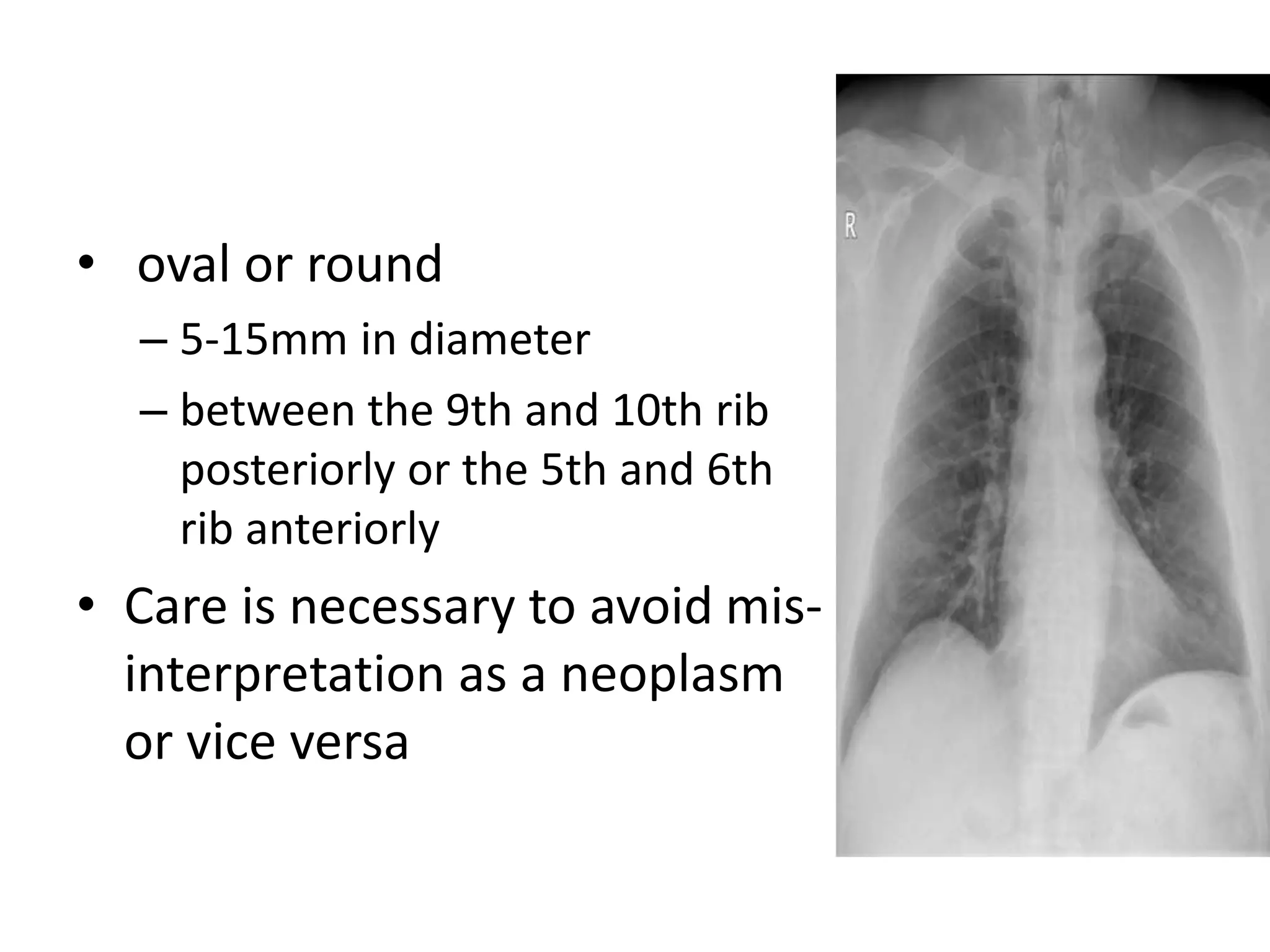 Learn Chest X-Ray With Its Normal Positioning & Radio-Anatomy | PPTX
