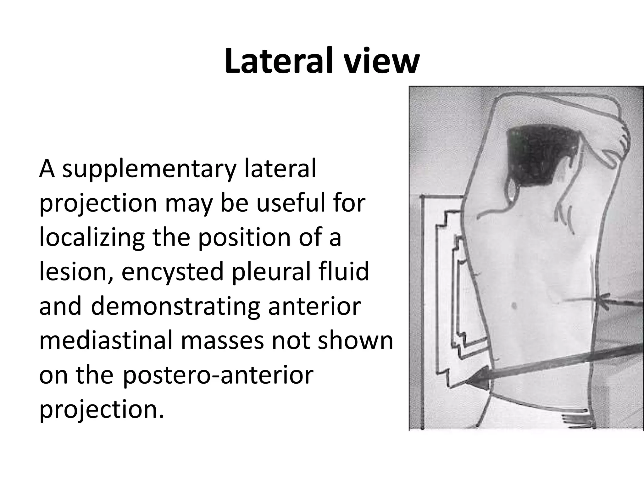 Learn Chest X-Ray With Its Normal Positioning & Radio-Anatomy | PPTX