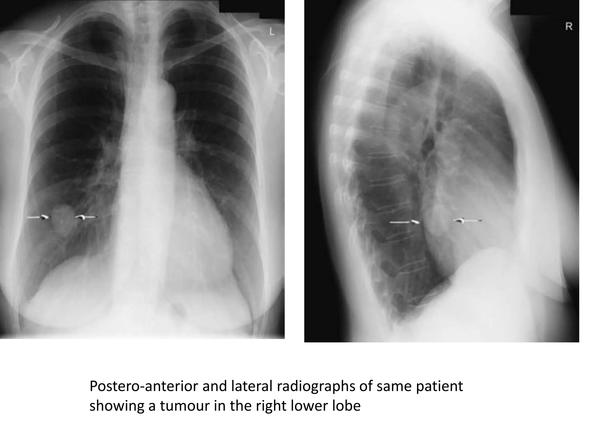 Learn Chest X-Ray With Its Normal Positioning & Radio-Anatomy | PPTX