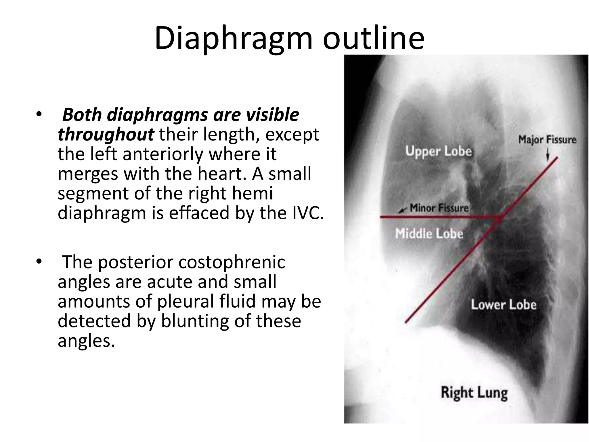 Learn Chest X-Ray With Its Normal Positioning & Radio-Anatomy | PPTX