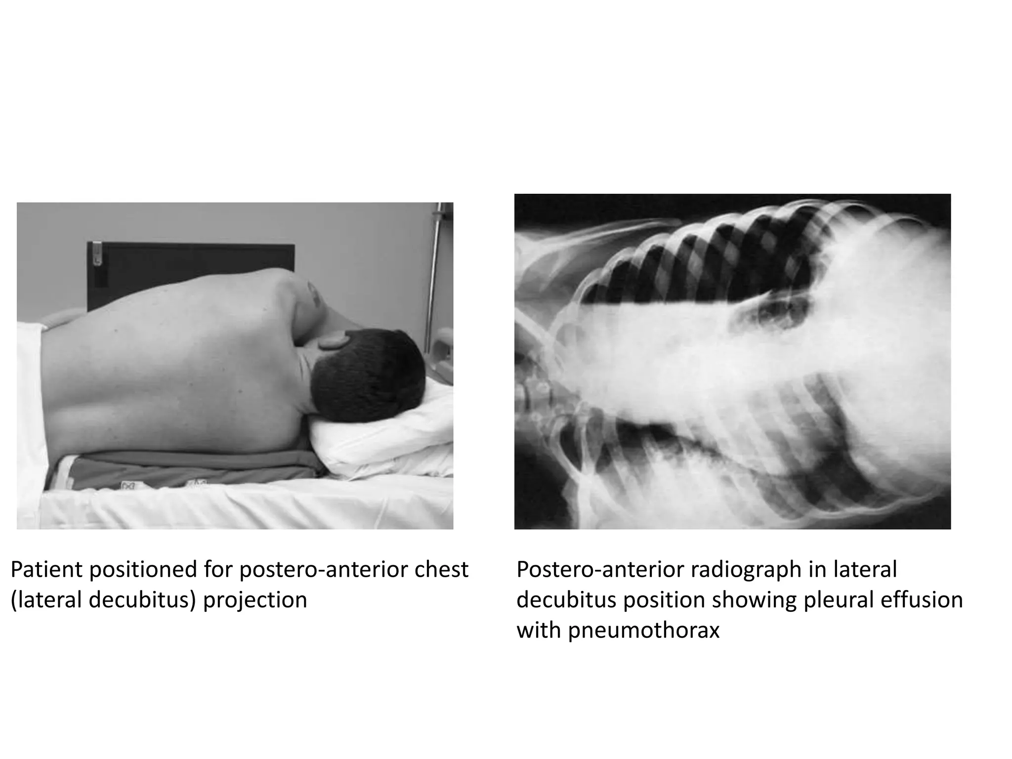 Learn Chest X-Ray With Its Normal Positioning & Radio-Anatomy | PPTX