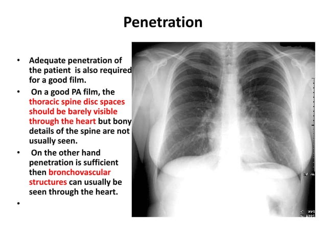 Learn Chest X-Ray With Its Normal Positioning & Radio-Anatomy | PPTX