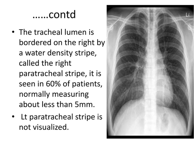 Learn Chest X-Ray With Its Normal Positioning & Radio-Anatomy | PPTX