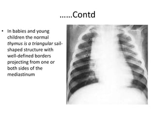 Learn Chest X-Ray With Its Normal Positioning & Radio-Anatomy | PPTX