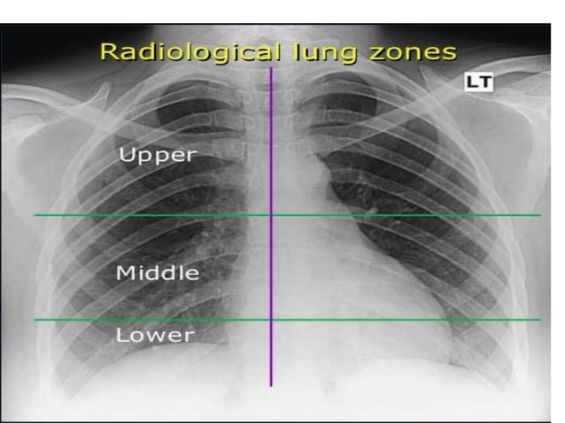 Learn Chest X-Ray With Its Normal Positioning & Radio-Anatomy | PPTX