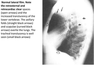 Learn Chest X-Ray With Its Normal Positioning & Radio-Anatomy | PPTX