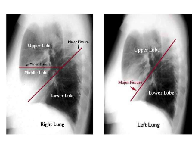 Learn Chest X-Ray With Its Normal Positioning & Radio-Anatomy | PPTX
