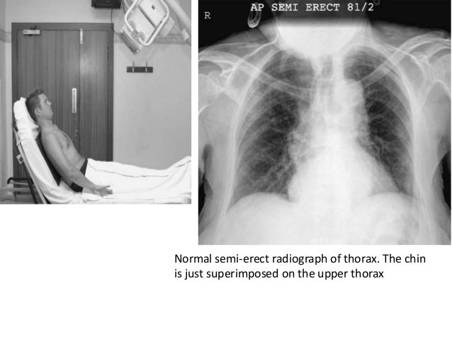 Learn Chest X-Ray With Its Normal Positioning & Radio-Anatomy