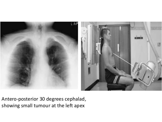 Learn Chest X-Ray With Its Normal Positioning & Radio-Anatomy
