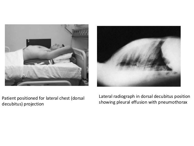 Learn Chest X-Ray With Its Normal Positioning & Radio-Anatomy