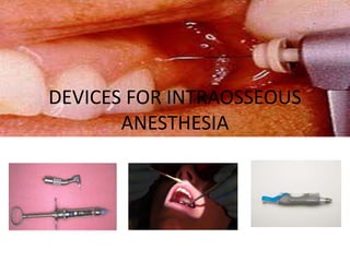 Newer techniques in local anesthesia delivery systems | PPTX