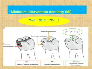 minimal intervension dentistry | PPT