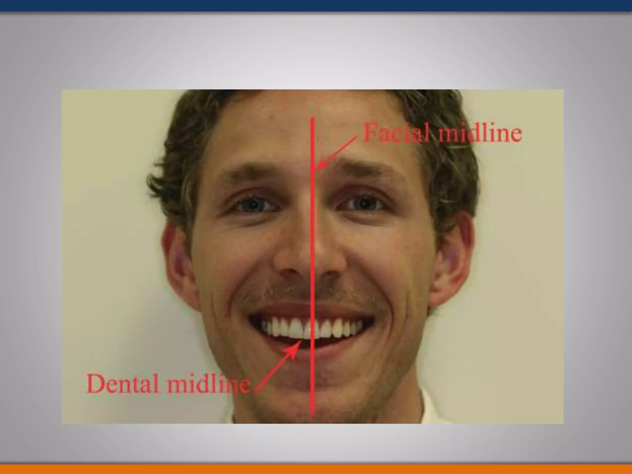 smile analysis in Orthodontics | PPTX