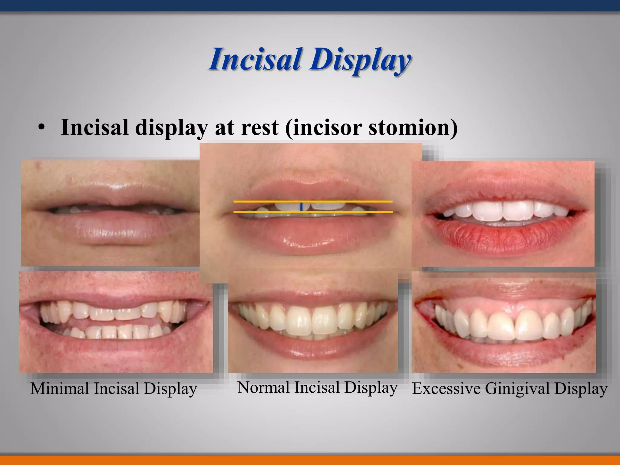 smile analysis in Orthodontics | PPTX