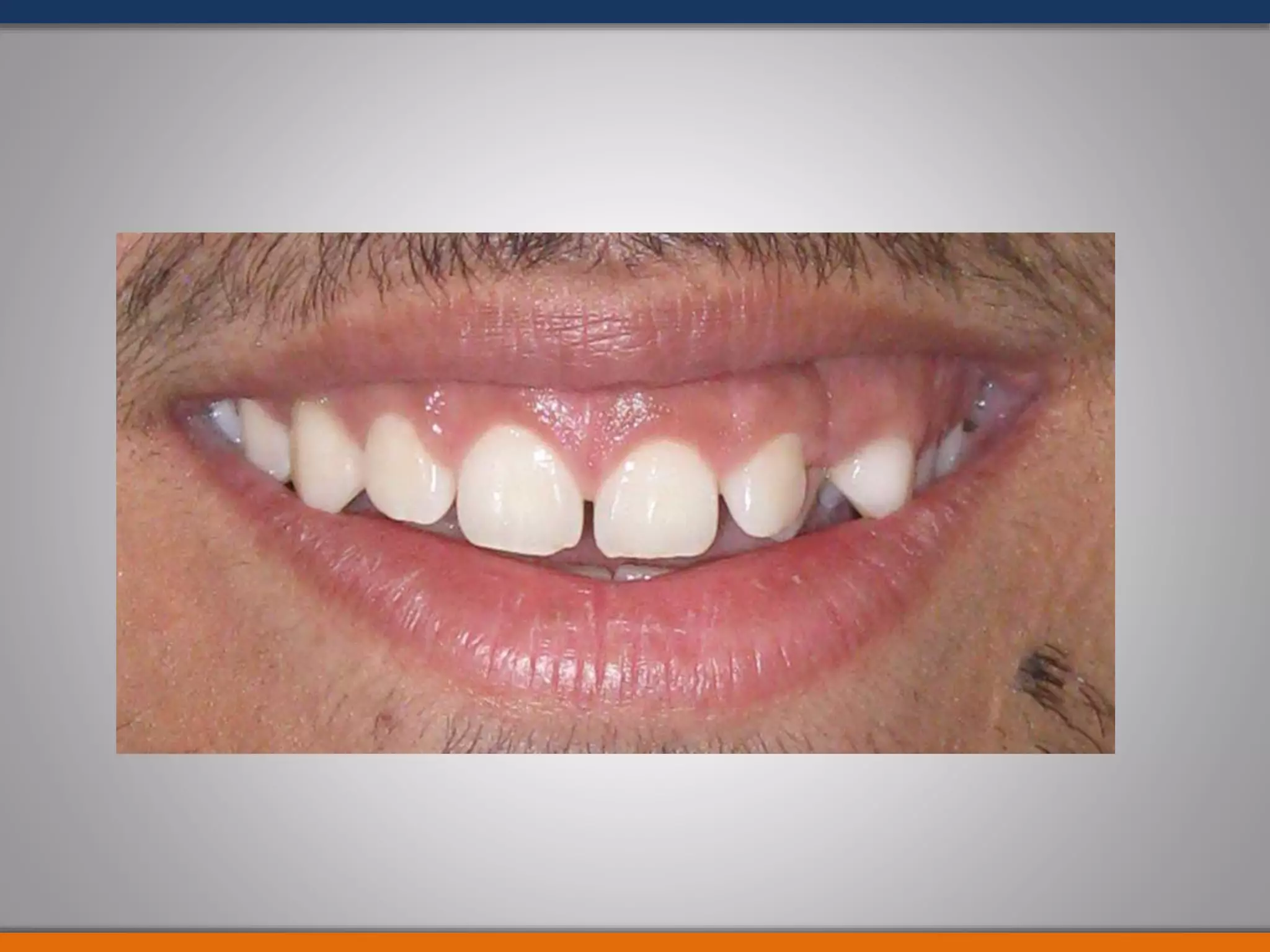smile analysis in Orthodontics | PPTX