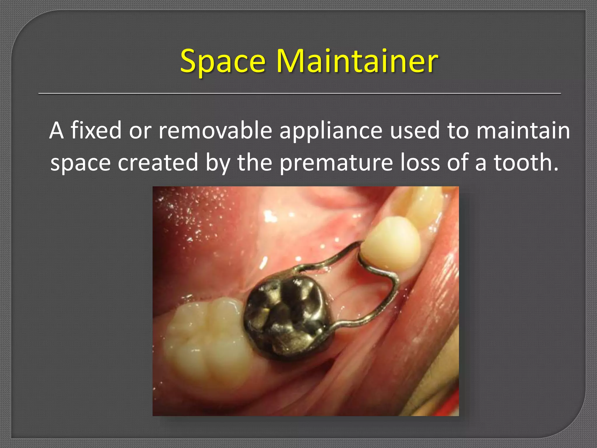 preventive orthodontics - space maintainers | PPTX
