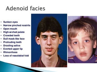 Adenoid Face Dentition