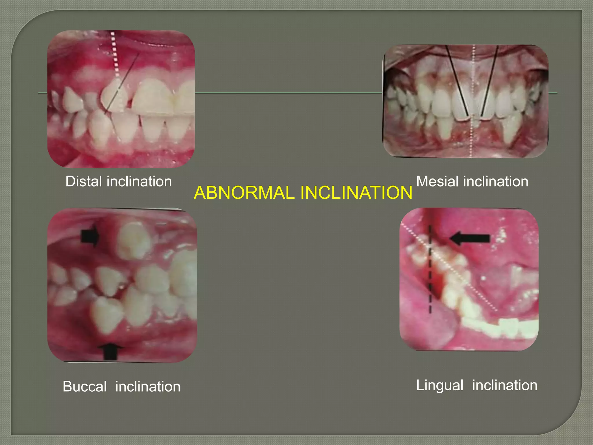 classification of malocclusion | PPTX