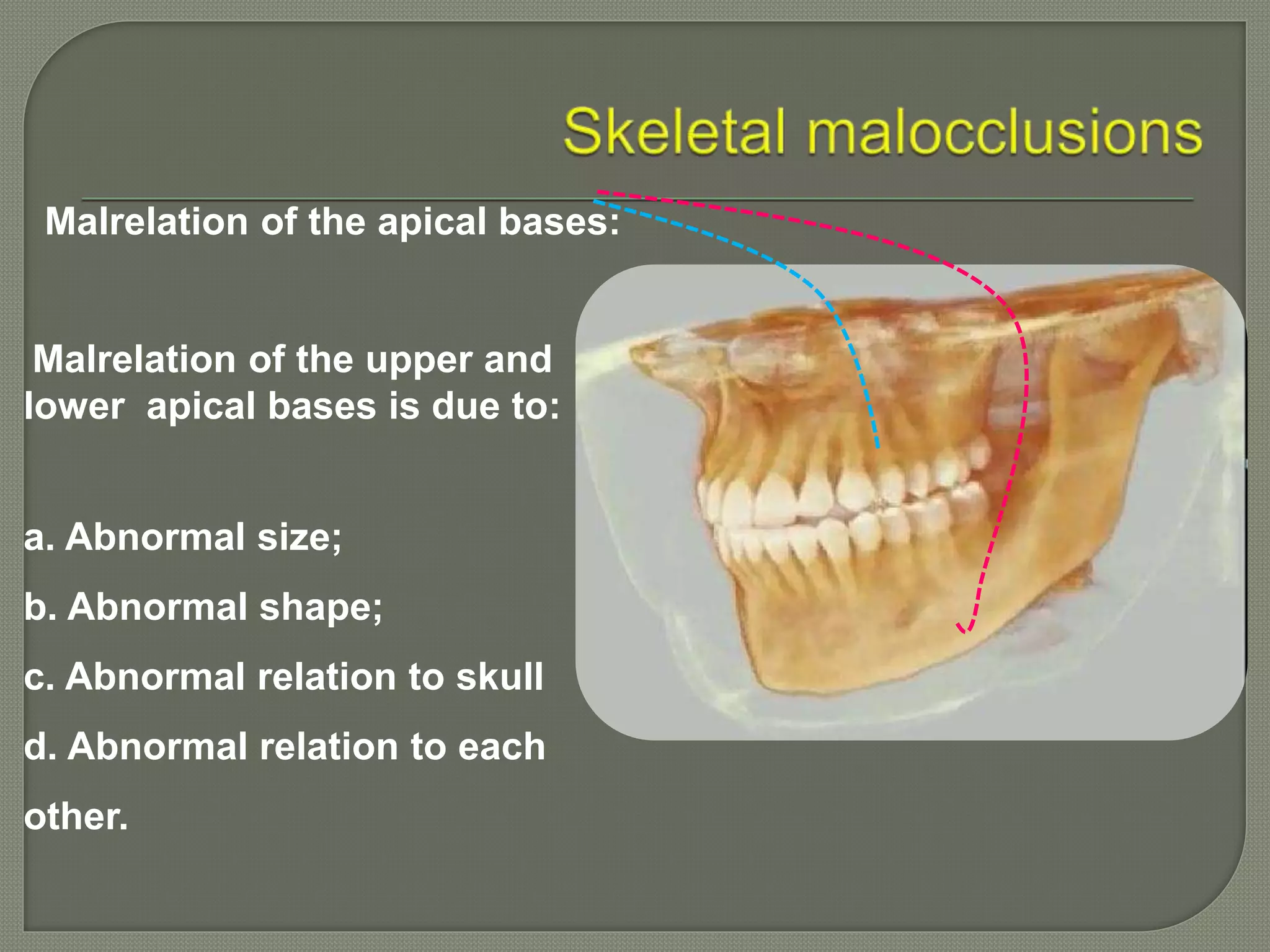 classification of malocclusion | PPTX