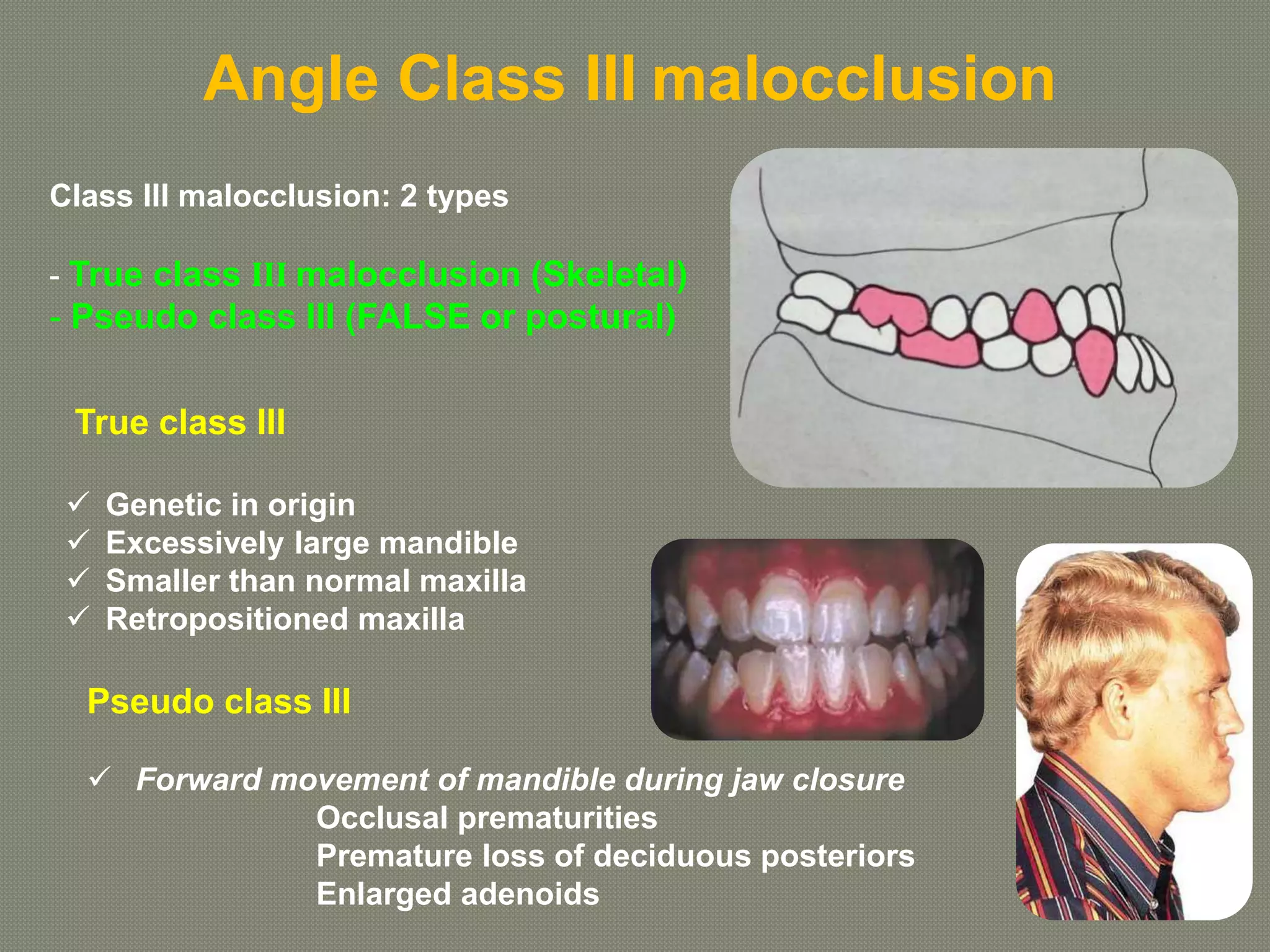 classification of malocclusion | PPTX