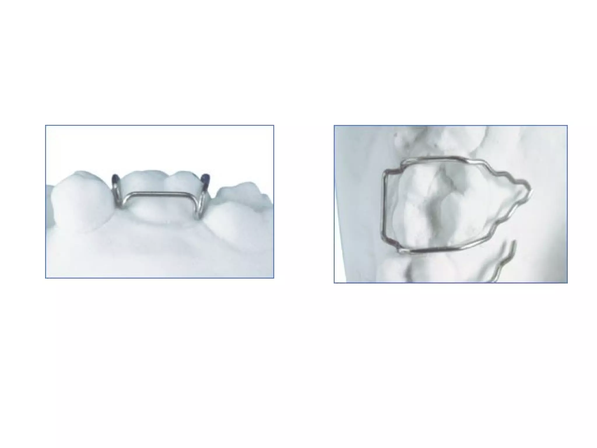 removable orthodontic appliances | PPT