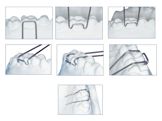 removable orthodontic appliances | PPT