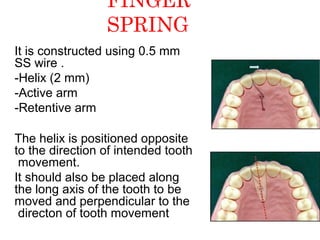 removable orthodontic appliances | PPT