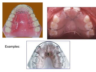 removable orthodontic appliances | PPT