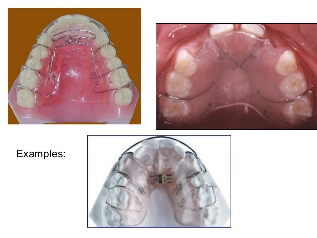 removable orthodontic appliances