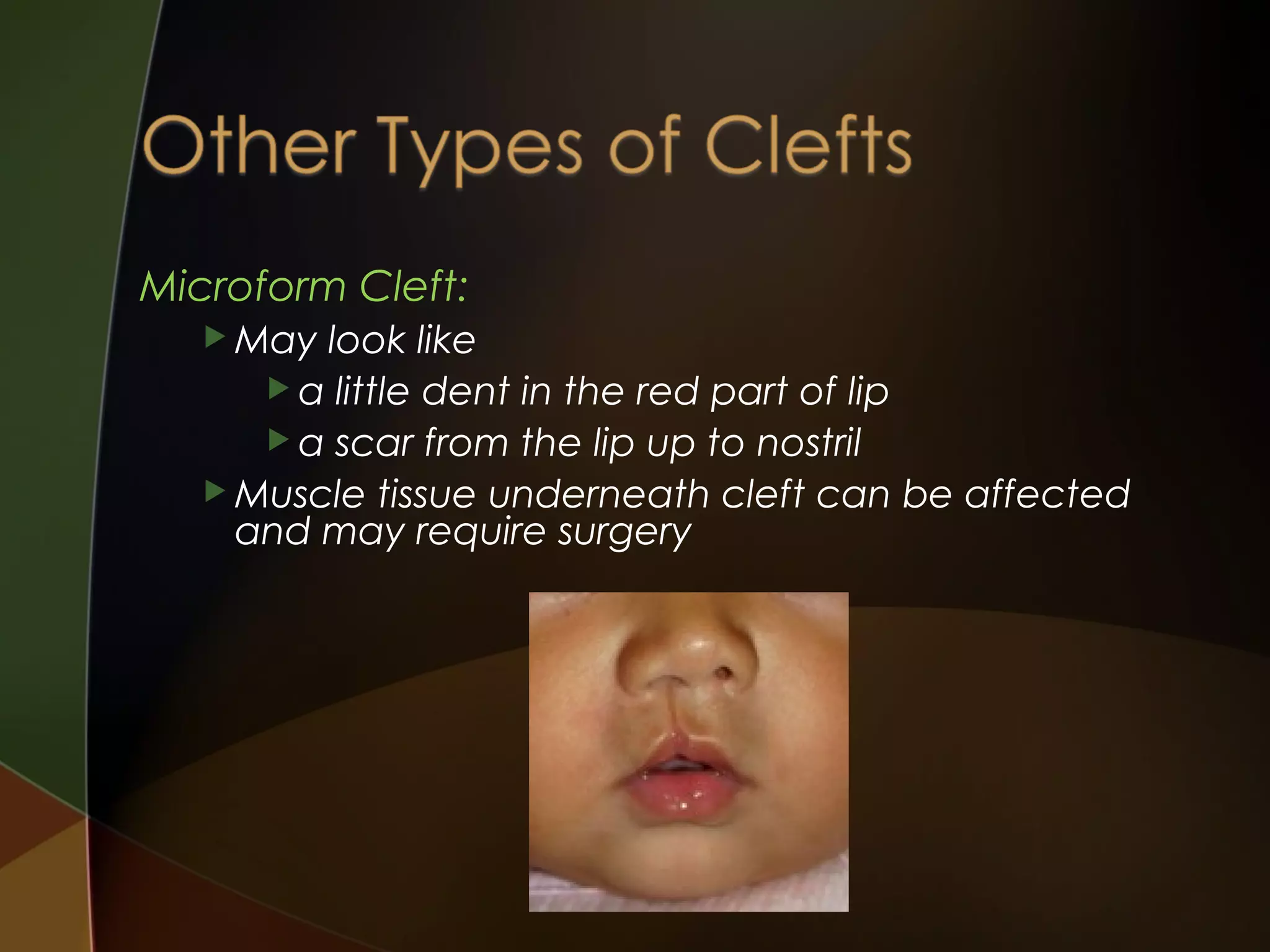 Cleft lip and palate - Introduction and Orthodontic Considerations | PPT