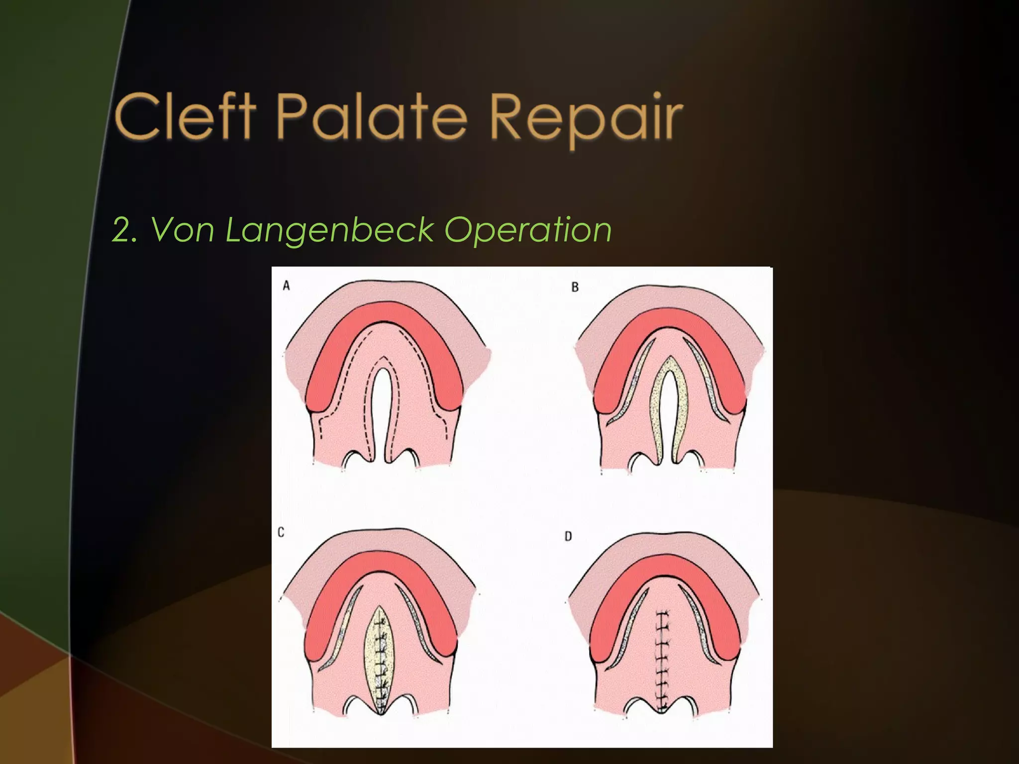 Cleft lip and palate - Introduction and Orthodontic Considerations | PPT