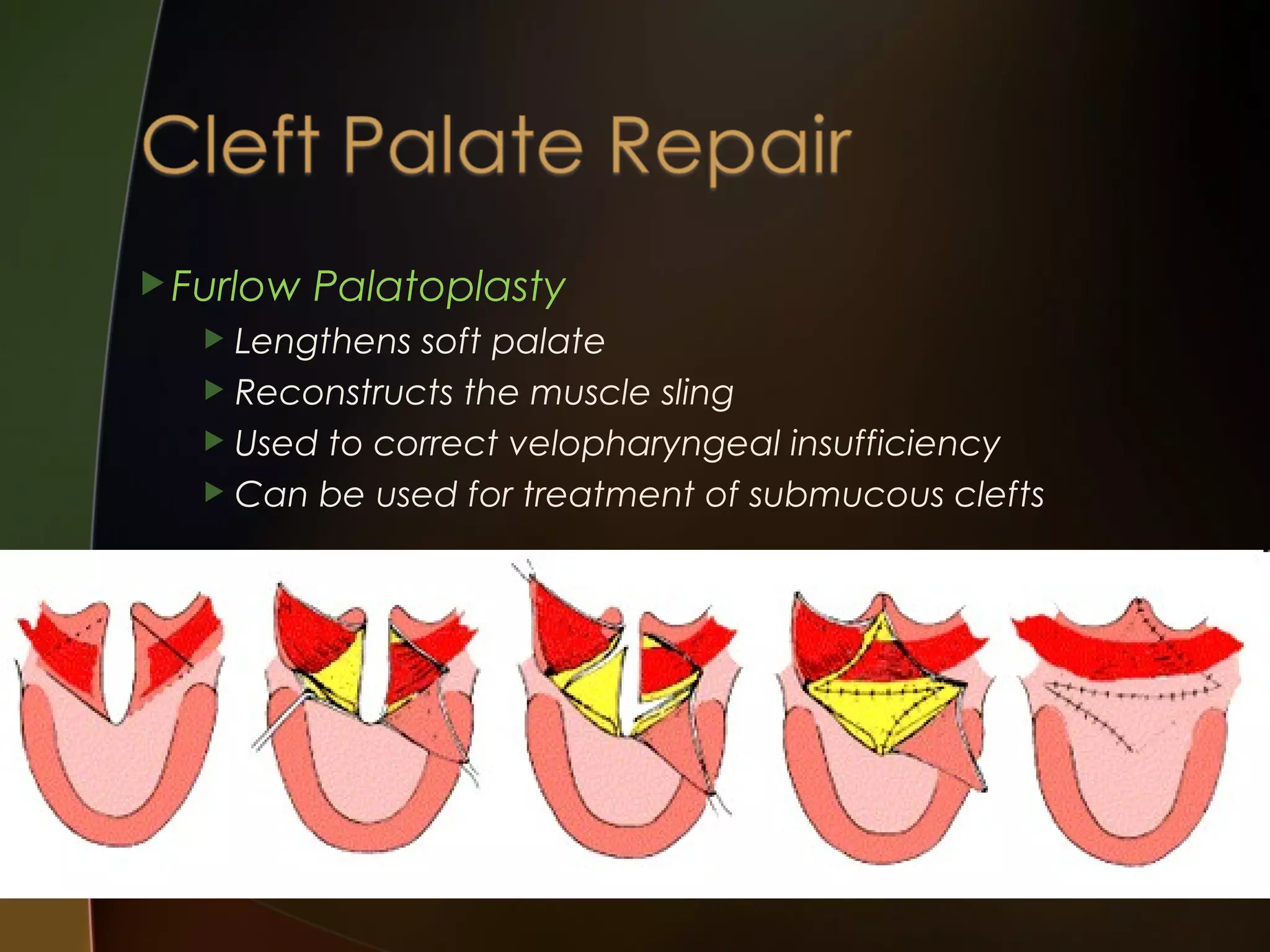 Cleft lip and palate - Introduction and Orthodontic Considerations | PPT