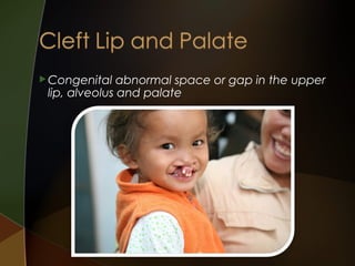 Cleft lip and palate - Introduction and Orthodontic Considerations | PPT