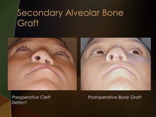Cleft lip and palate - Introduction and Orthodontic Considerations | PPT
