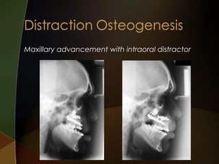 Cleft lip and palate - Introduction and Orthodontic Considerations | PPT