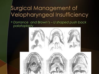 Cleft lip and palate - Introduction and Orthodontic Considerations | PPT