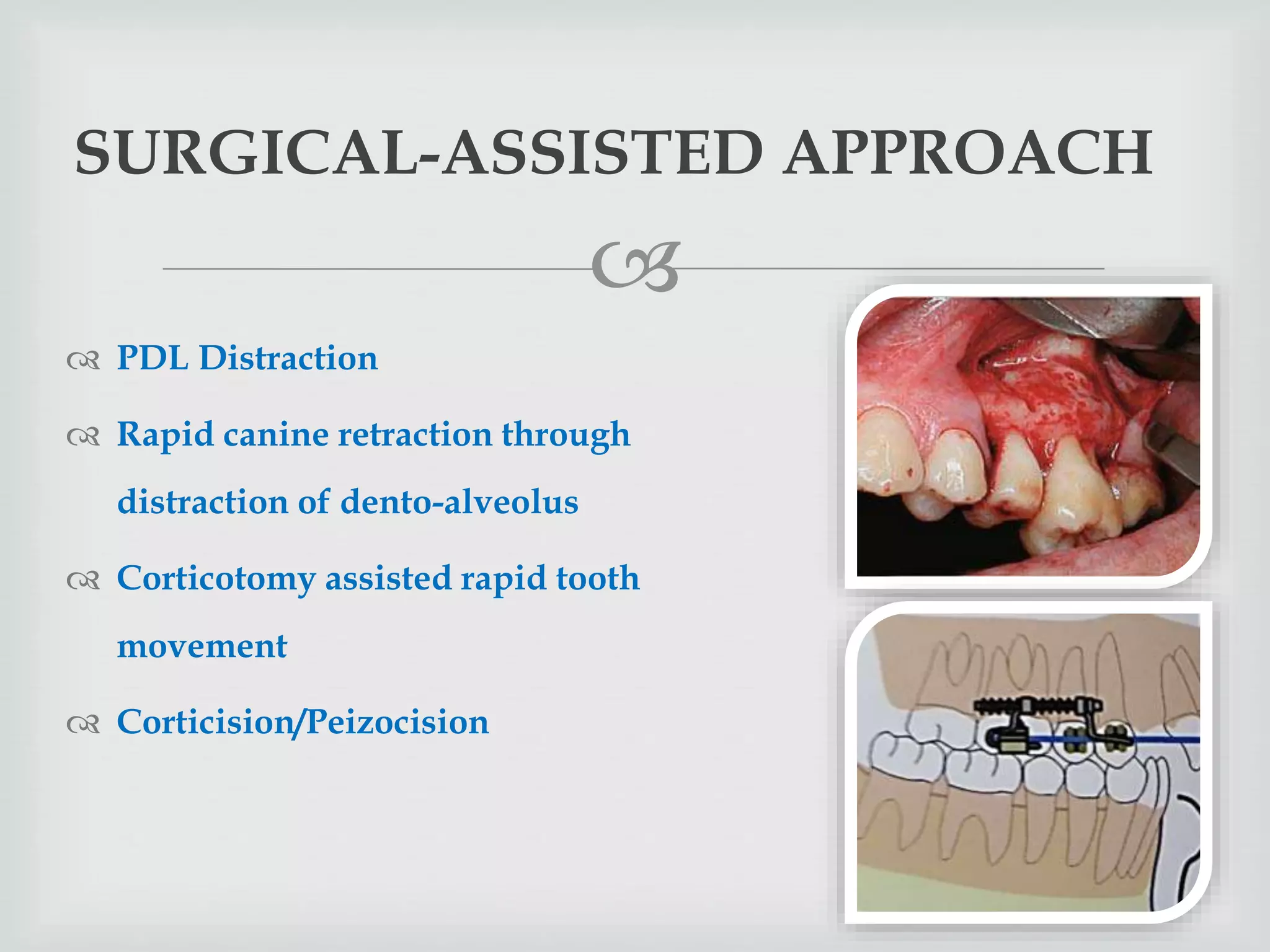 biology of tooth movement ii | PPTX | Bone and Joint Conditions ...