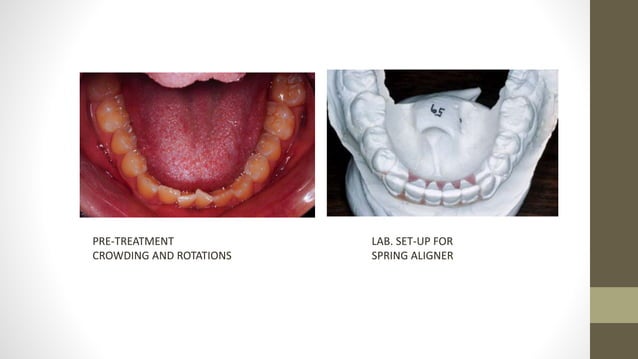 Retention and relapse | PPTX