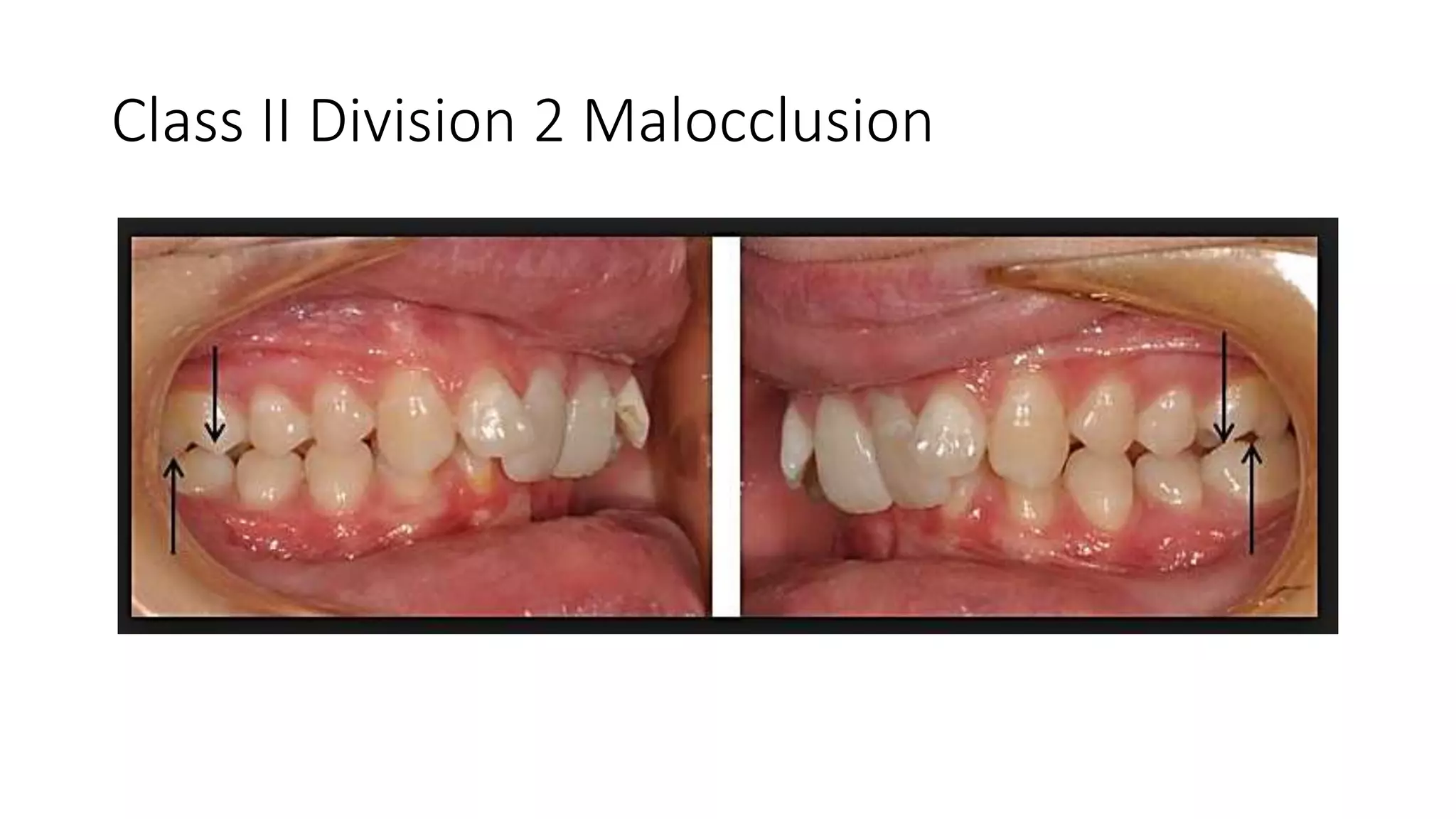 management of class ii and iii malocclusion | PPTX